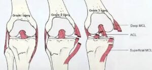 MCL SPRAIN GRADE - MCL SPRAIN